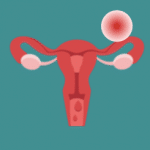 Grossesse extra utérine (GEU) - Ressource KitMédical