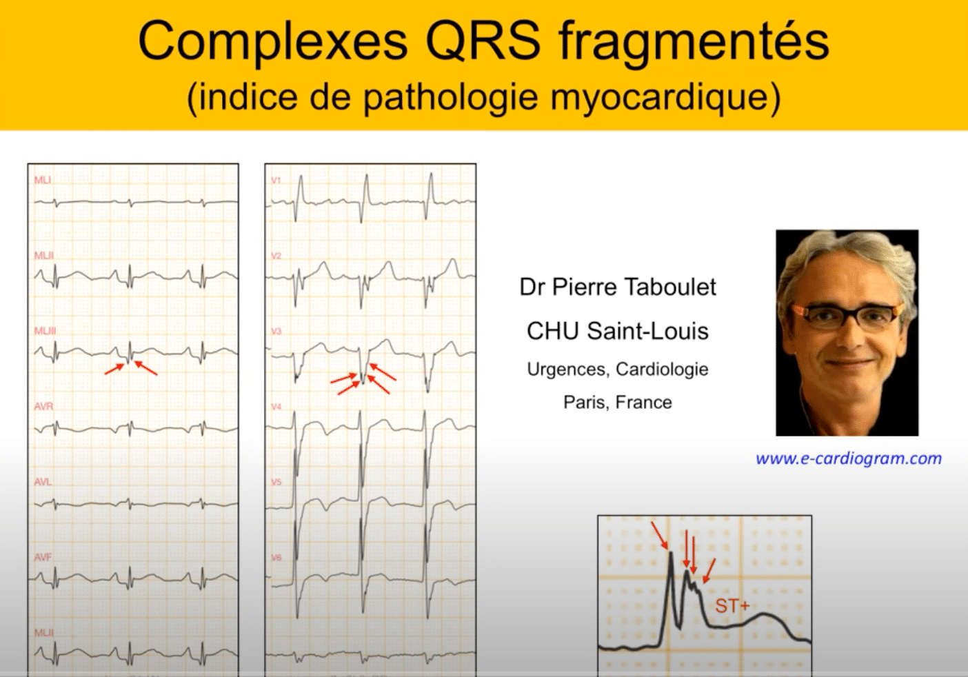 ECG -8 - Ressource KitMédical